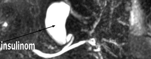 Insulinom